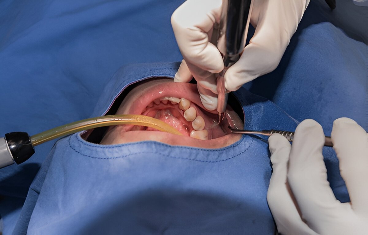 Root Canal Treatment in Sarasota, FL | Root Canal Near Me